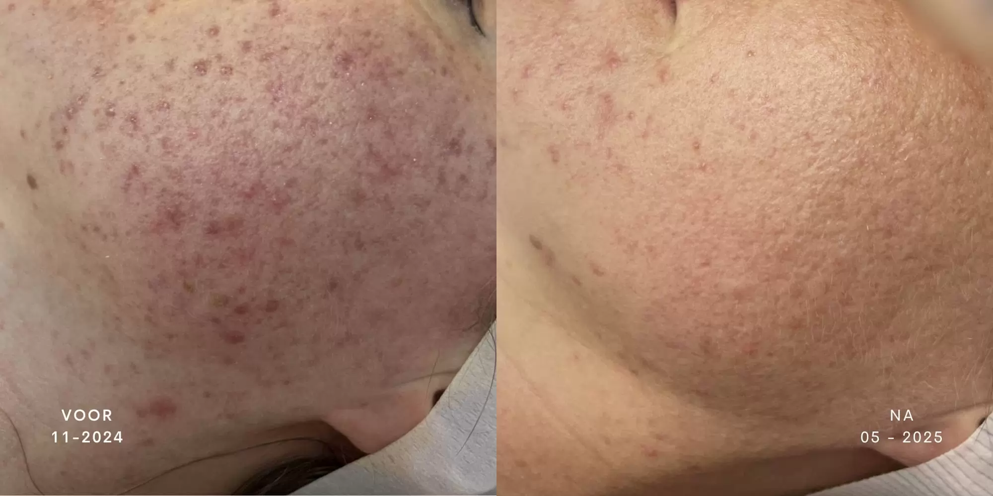 Acne-littekens verwijderen | Huid.com - Huid.com
